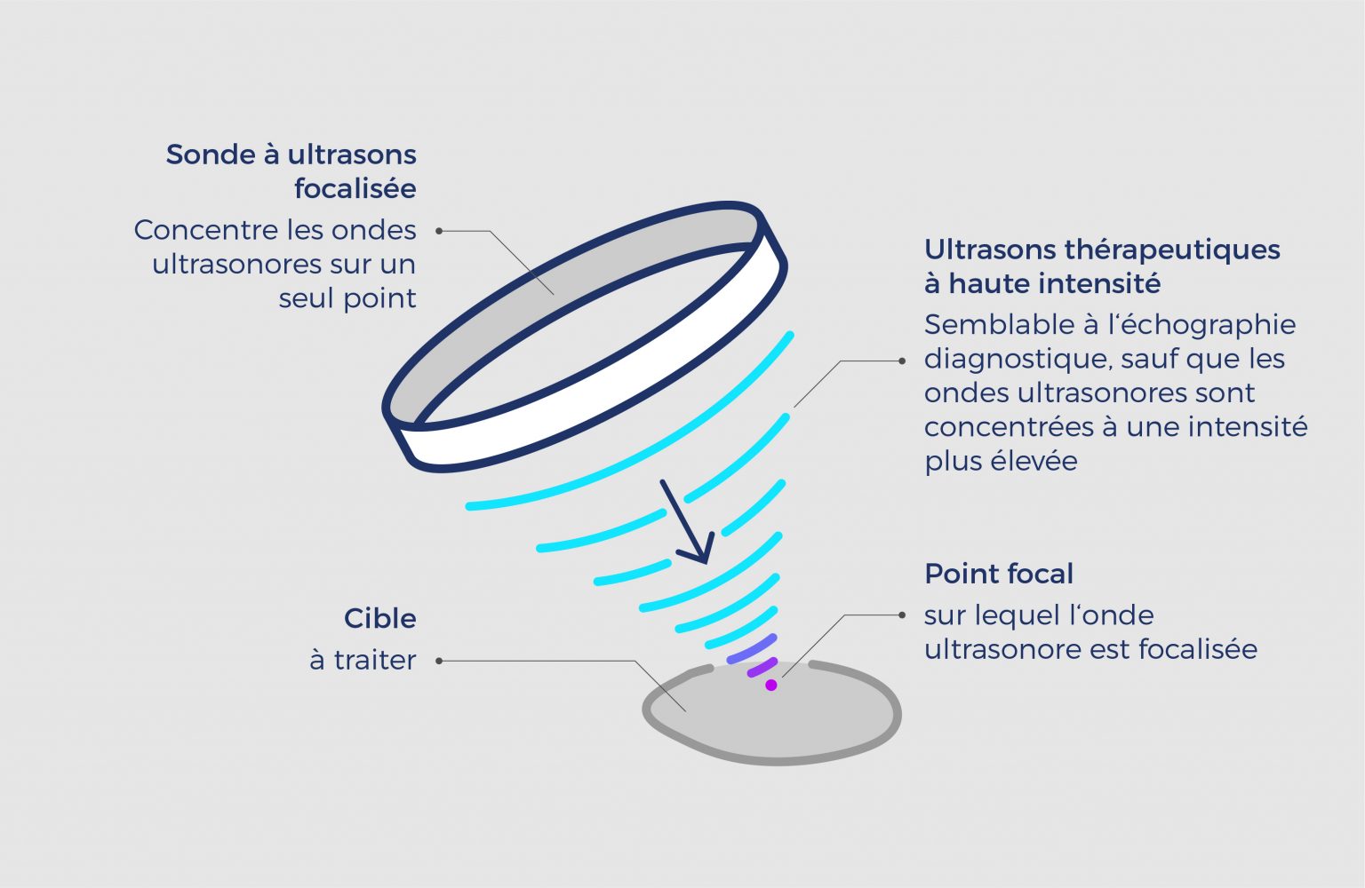 Comment fonctionnent les ultrasons dans le traitement des varices ...